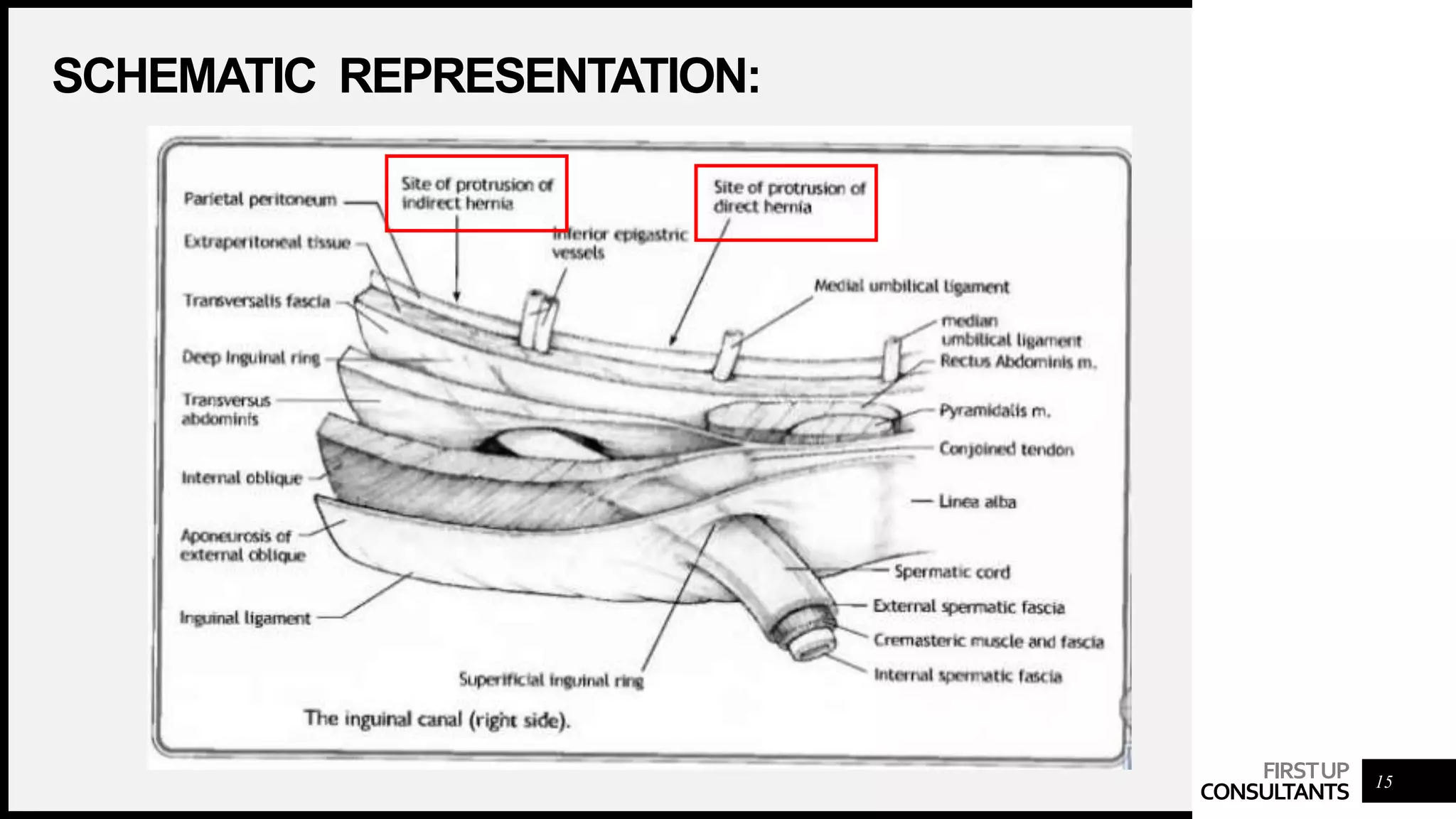 Hernias definition, types, surgical anatomy of inguinal hernia | PPTX