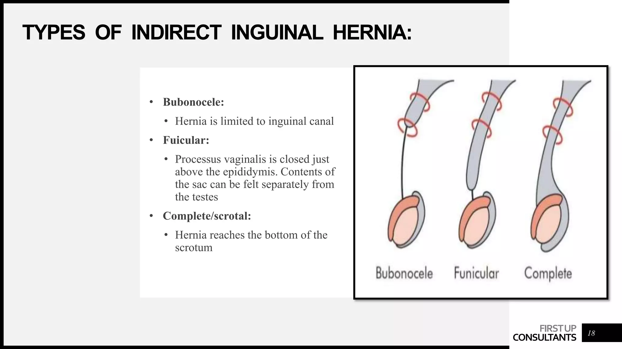 Hernias definition, types, surgical anatomy of inguinal hernia | PPTX