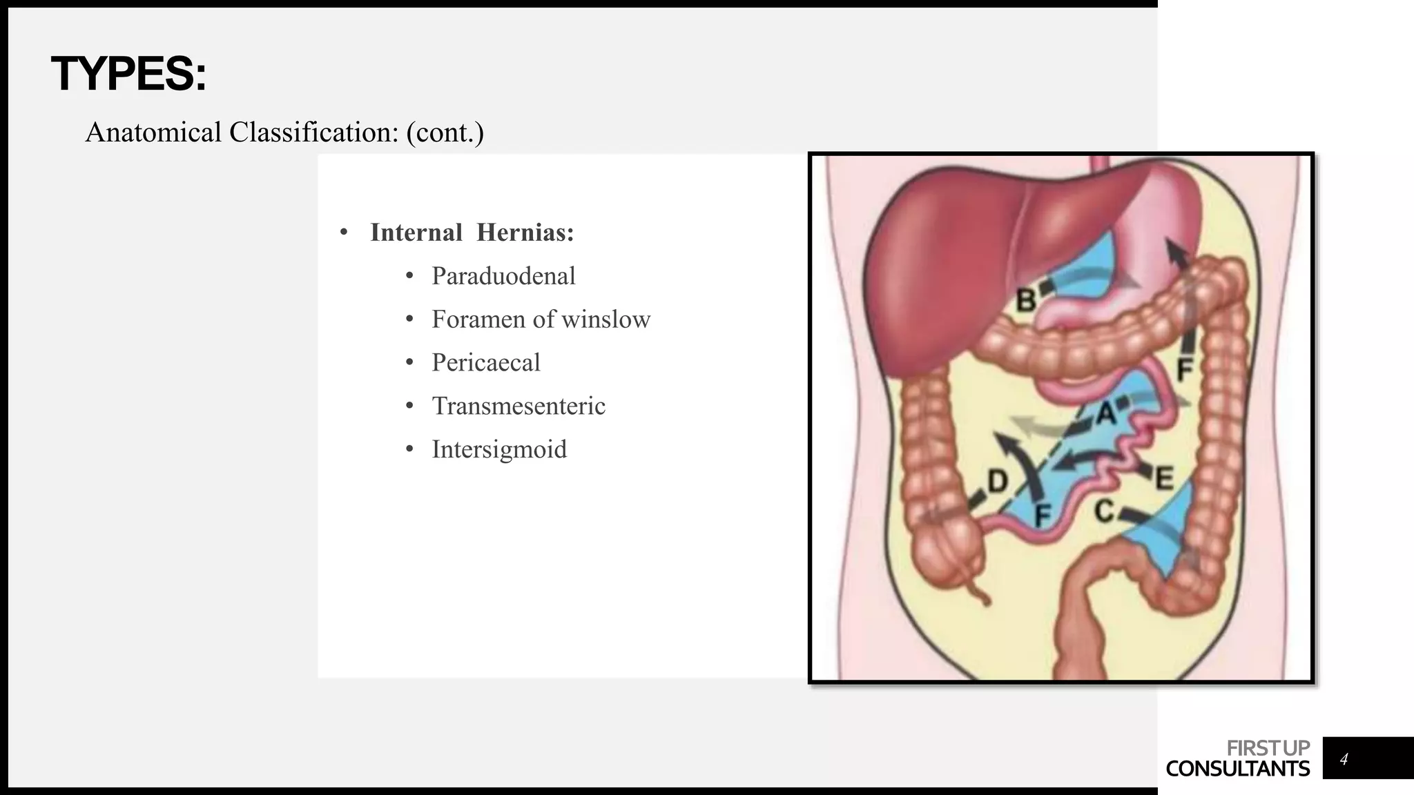 Hernias definition, types, surgical anatomy of inguinal hernia | PPTX