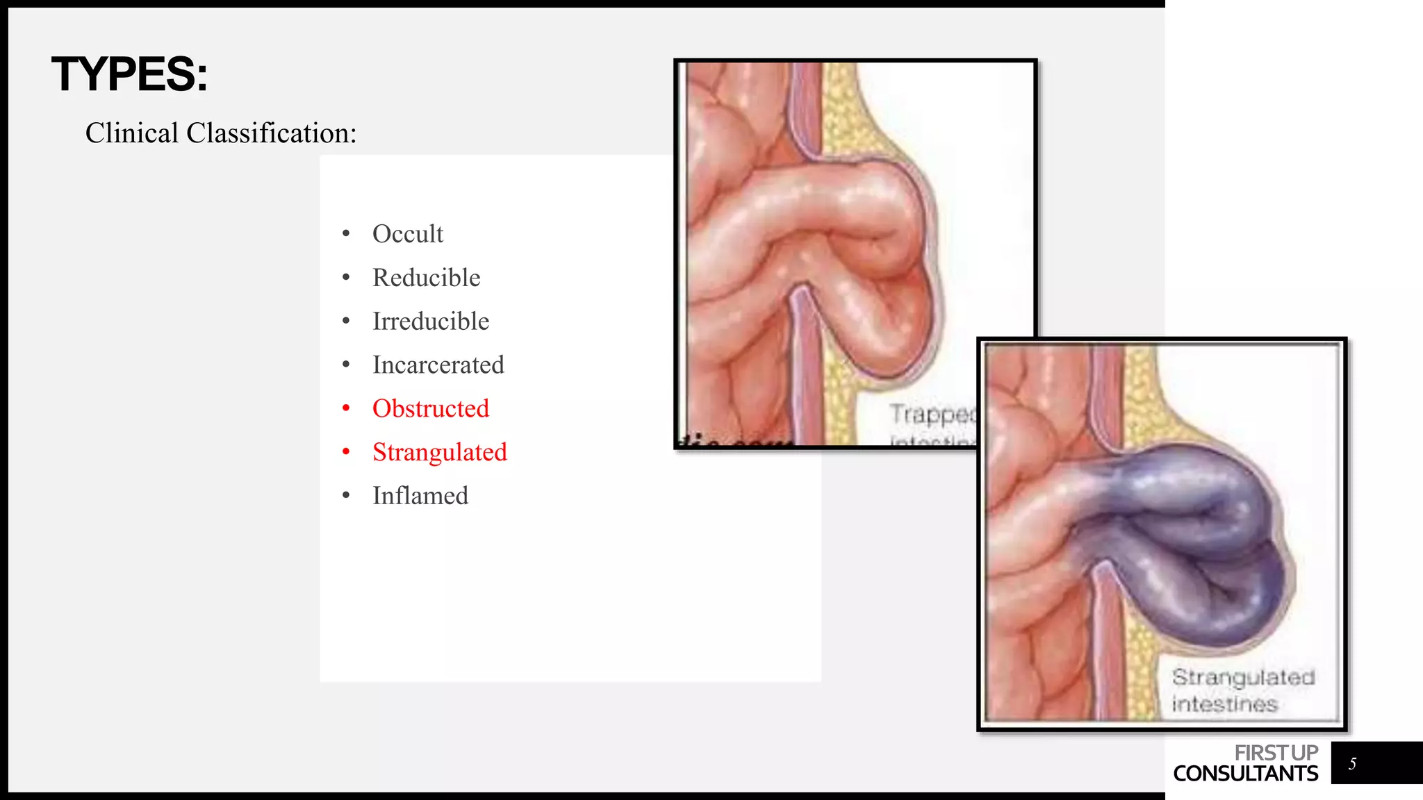 Hernias Definition Types Surgical Anatomy Of Inguinal Hernia Pptx