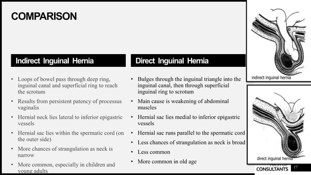 Hernias definition, types, surgical anatomy of inguinal hernia | PPT