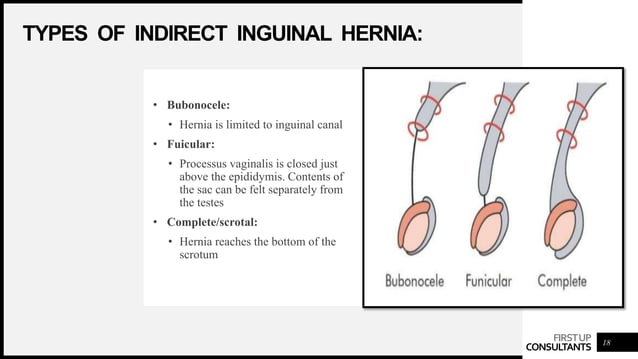 Hernias definition, types, surgical anatomy of inguinal hernia | PPT