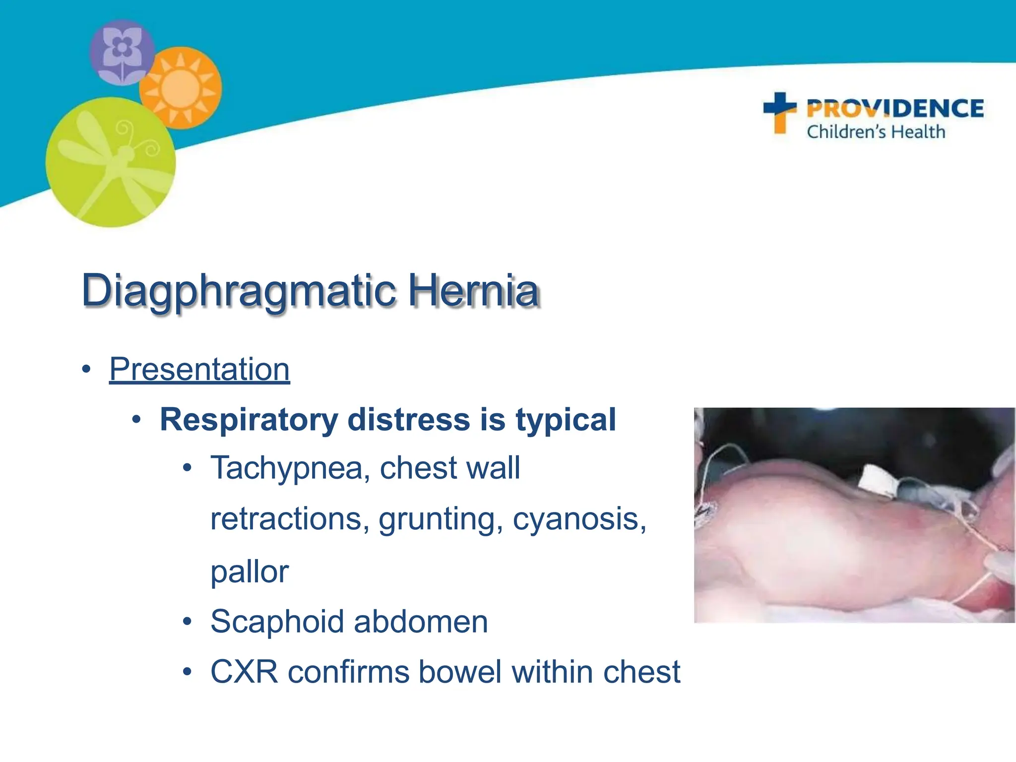 PEDIATRRIC HERNIA WHAT DO AND WHEE -Dr-Gause.pptx