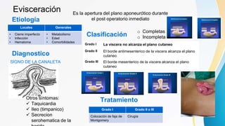 Hernias-eventración-evisceración y traumatismo abdominal)..pptx