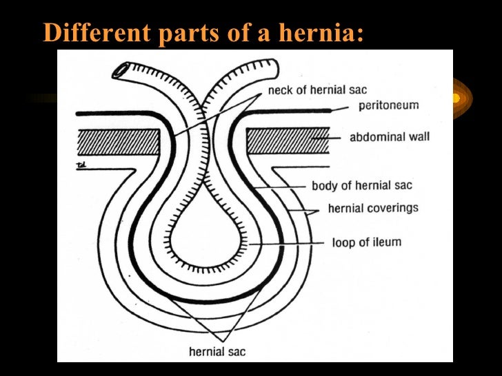 Hernias1