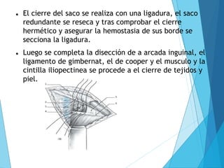 Hernias inguinal, crural, epigastrica | PPTX