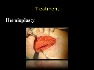 Hernias | PPTX