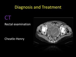 Hernias | PPTX