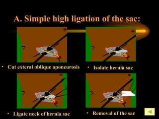 Hernias2 | PPT