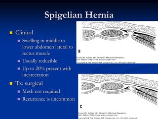 Hernias 2.ppt