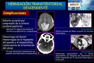 Hernias cerebrales.ppt