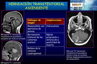 Hernias cerebrales.ppt