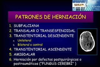 Hernias cerebrales.ppt