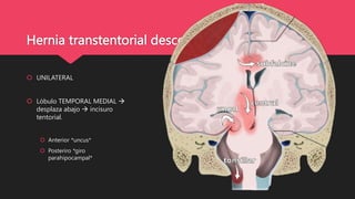 HERNIAS Cerebrales tomografía y mas.pptx