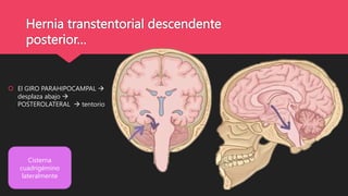 HERNIAS Cerebrales tomografía y mas.pptx