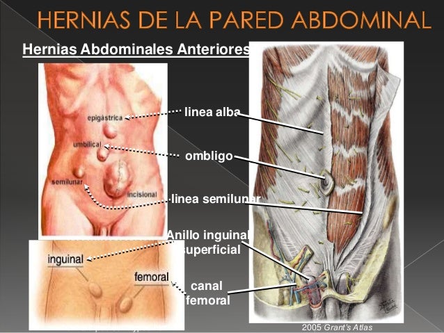 hernias de la pared abdominal – PZGI