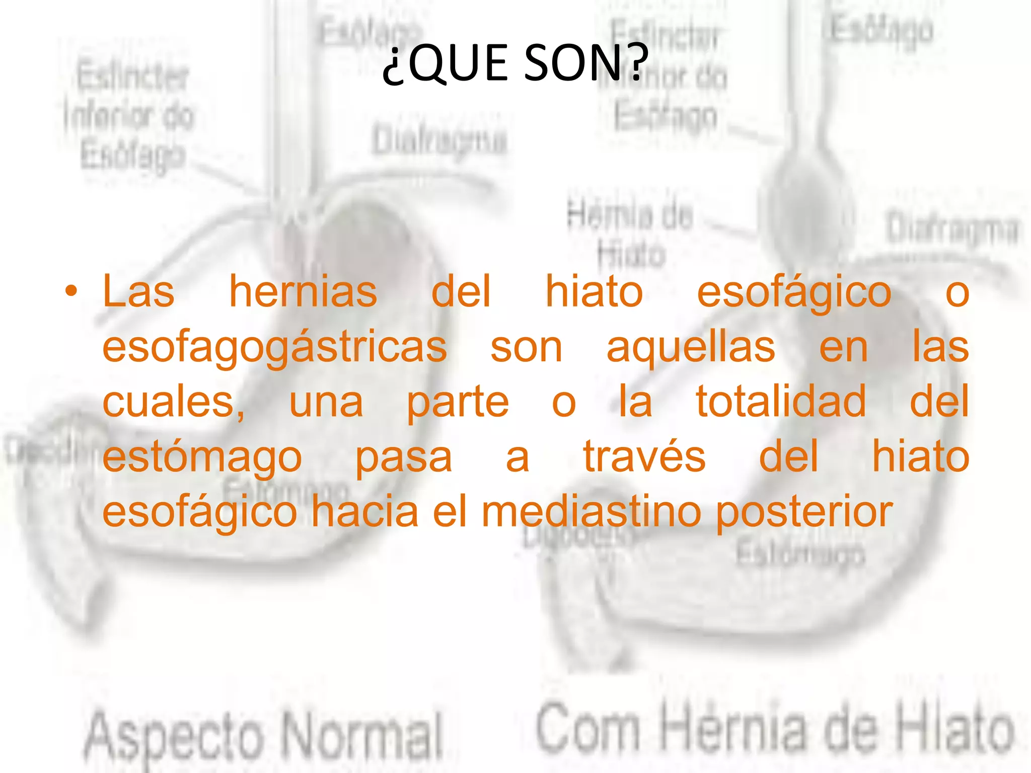 Hernias del hiato esofágico y diafragma | PPTX