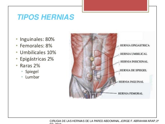 Hernias de pared abdominal
