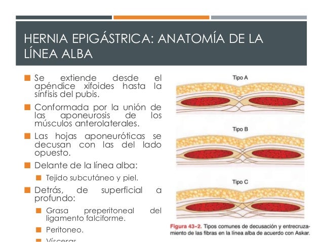 Linea Alba Hernia
