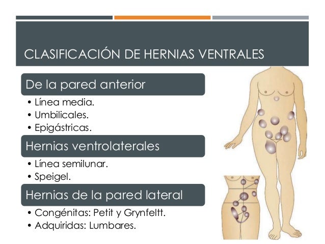 Hernias de pared abdominal anterior