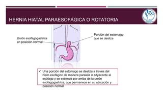 Hernias diafragmáticas | PPTX
