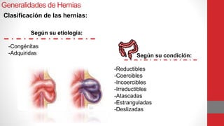 HERNIAS FINAL JEJE.pptx