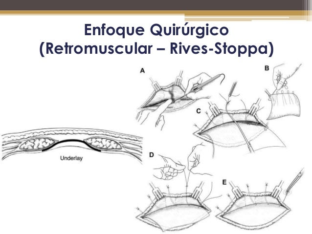 CIRUGIA DE EVENTRACIONES GIGANTES