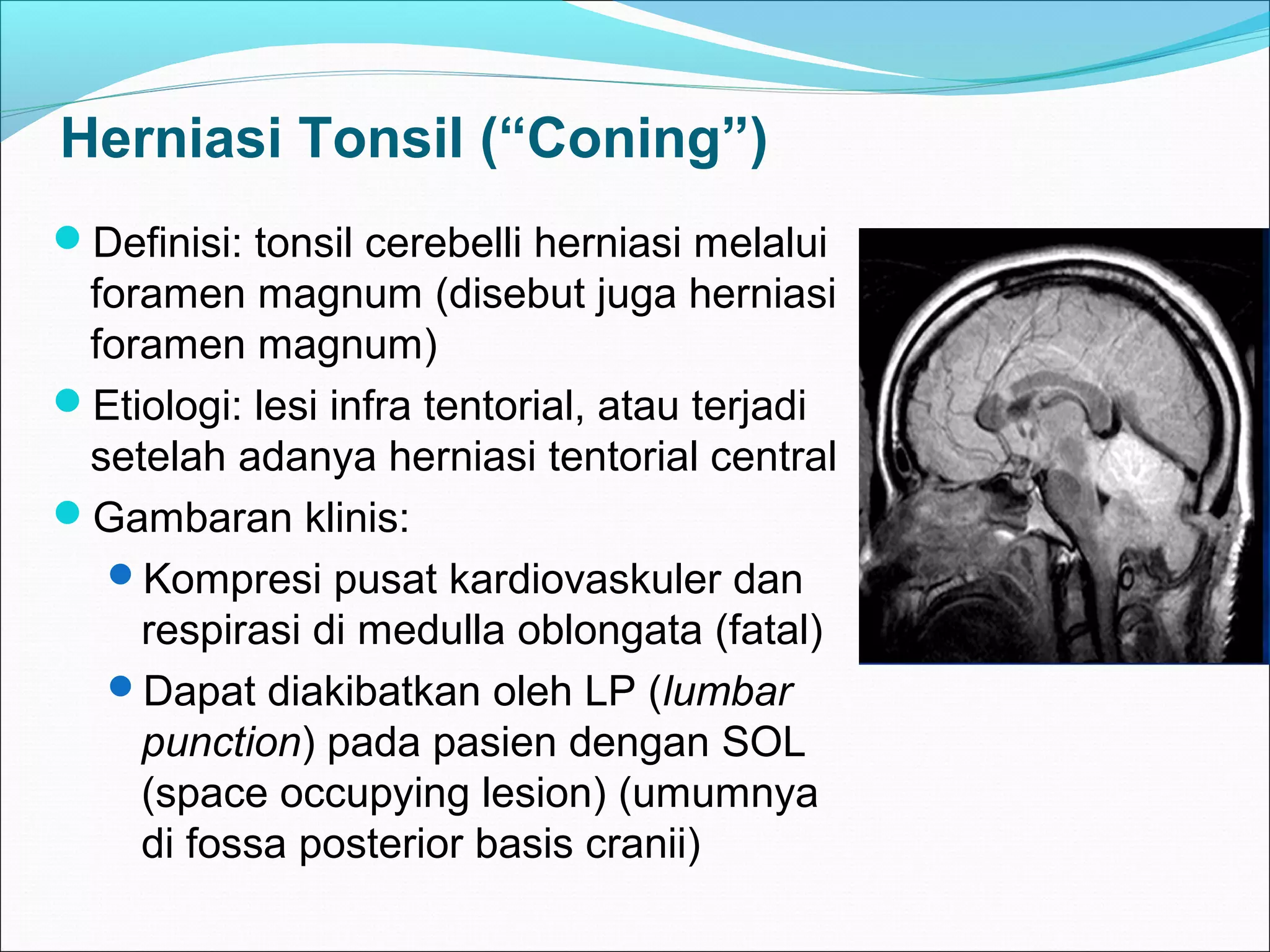 Herniasi Otak | PPT