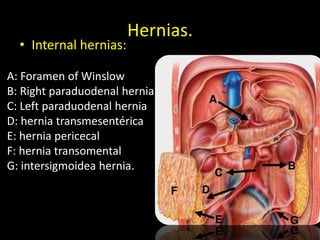 Hernias ingl | PPTX
