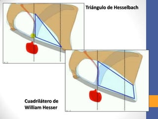 Hernias inguinales | PPTX