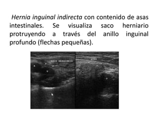 Hernias inguinales | PPTX