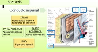 Hernias inguinales | PPTX