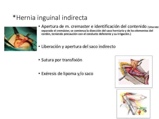 ¿Qué Es Una Hernia Inguinal? | Conducto inguinal: Anatomía, contenido y ...