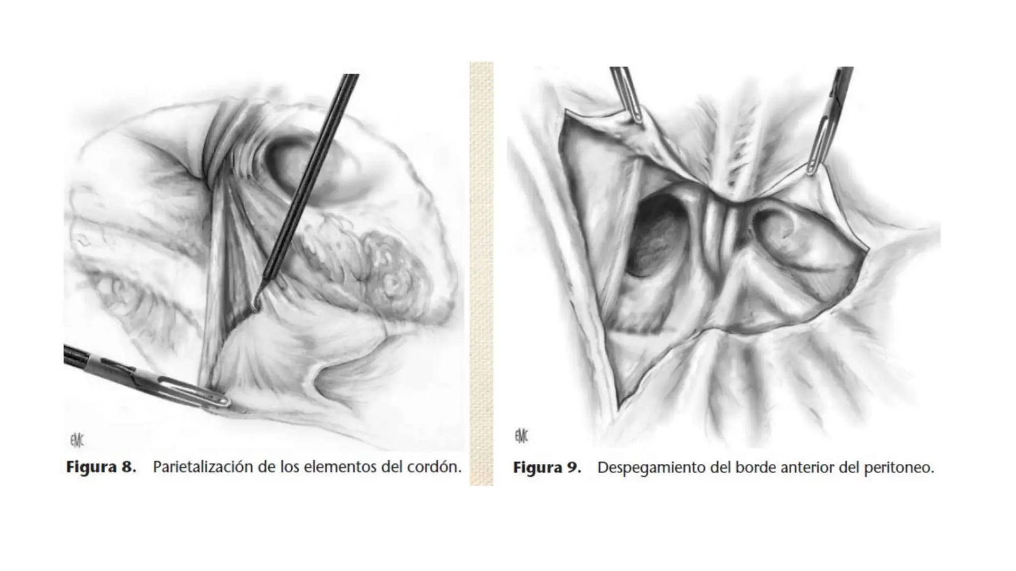 hernias inguinocrural. HERNIA HERNIA HERNIA HERNIA | PPTX