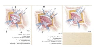 hernias inguinocrural. HERNIA HERNIA HERNIA HERNIA | PPTX
