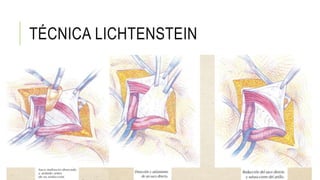 hernias inguinocrural. HERNIA HERNIA HERNIA HERNIA | PPTX