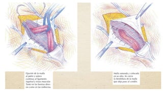 hernias inguinocrural. HERNIA HERNIA HERNIA HERNIA | PPTX