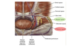 hernias inguinocrural. HERNIA HERNIA HERNIA HERNIA | PPTX