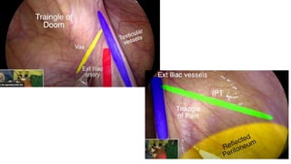 hernias inguinocrural. HERNIA HERNIA HERNIA HERNIA | PPTX