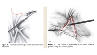 hernias inguinocrural. HERNIA HERNIA HERNIA HERNIA | PPTX