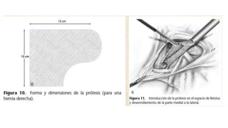hernias inguinocrural. HERNIA HERNIA HERNIA HERNIA | PPTX