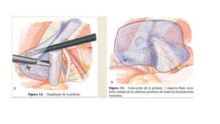 hernias inguinocrural. HERNIA HERNIA HERNIA HERNIA | PPTX
