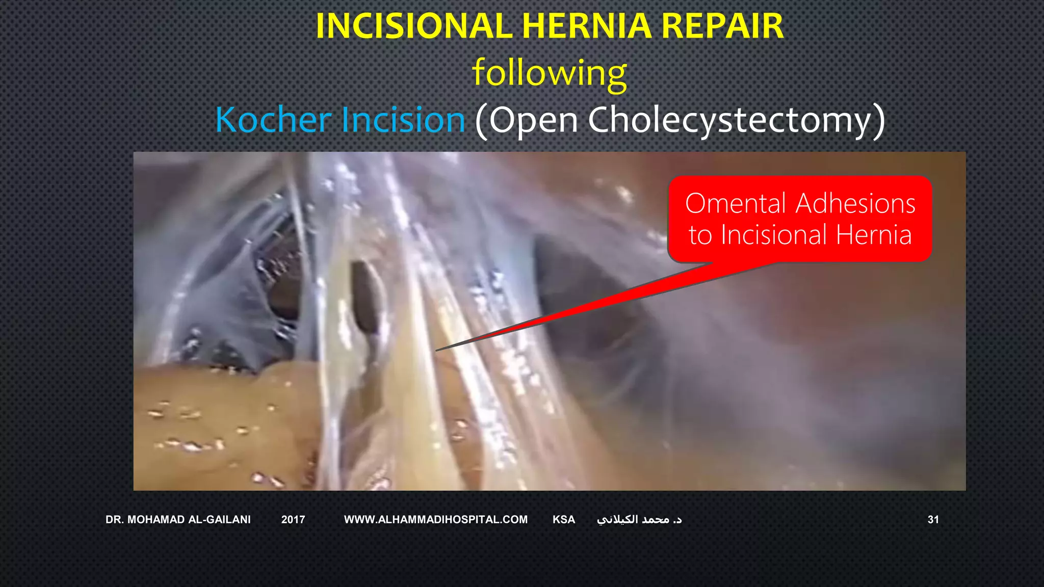 Hernia Repair: Open or Laparoscopic? | PPTX