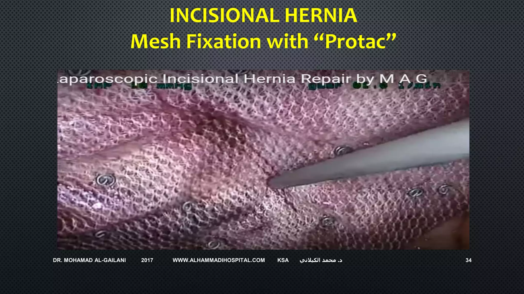 Hernia Repair: Open or Laparoscopic? | PPTX