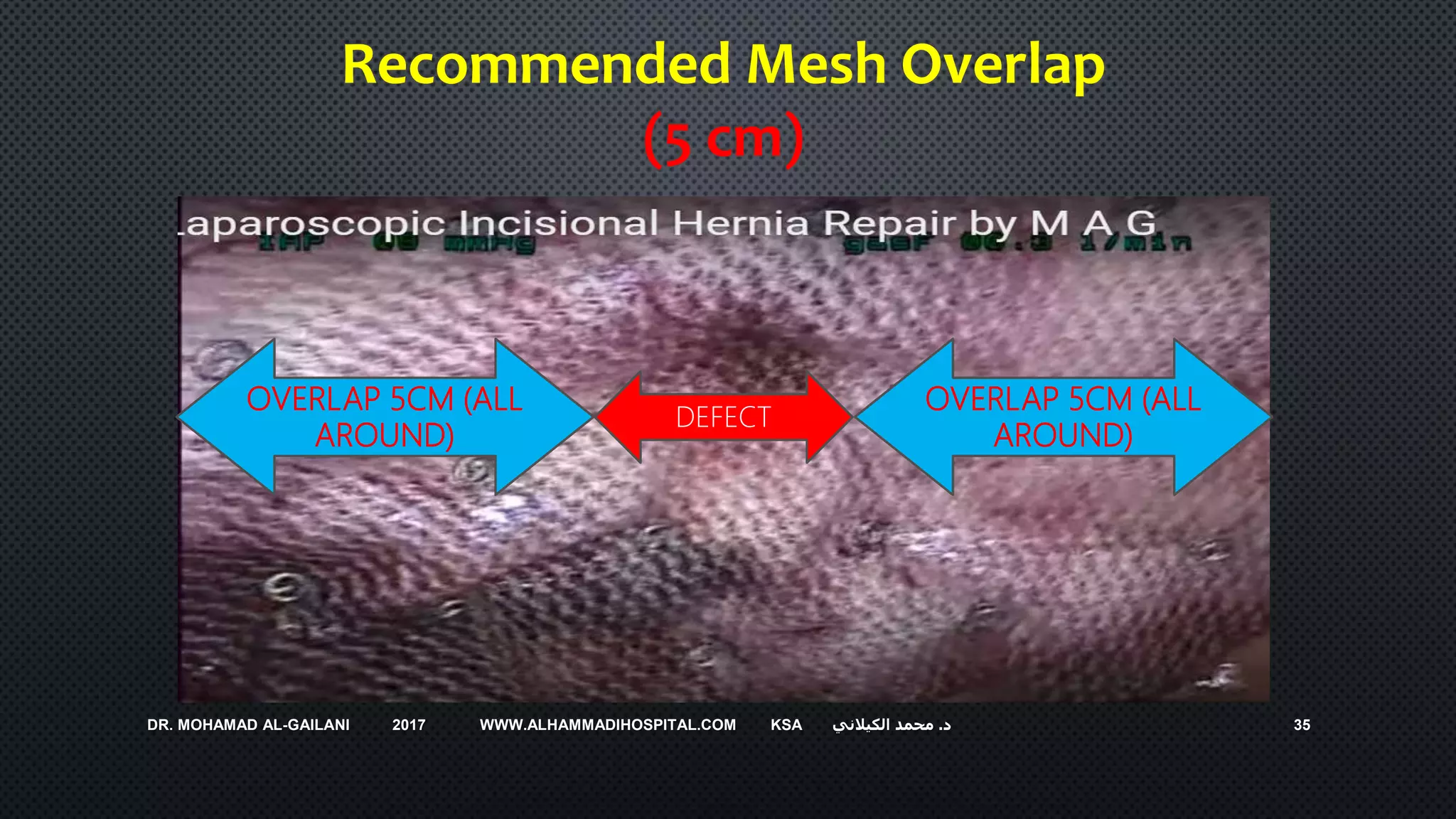 Hernia Repair: Open or Laparoscopic? | PPTX