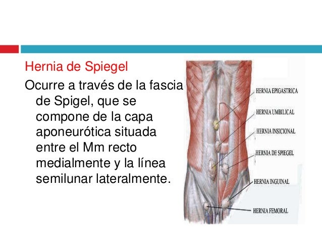 Hernias