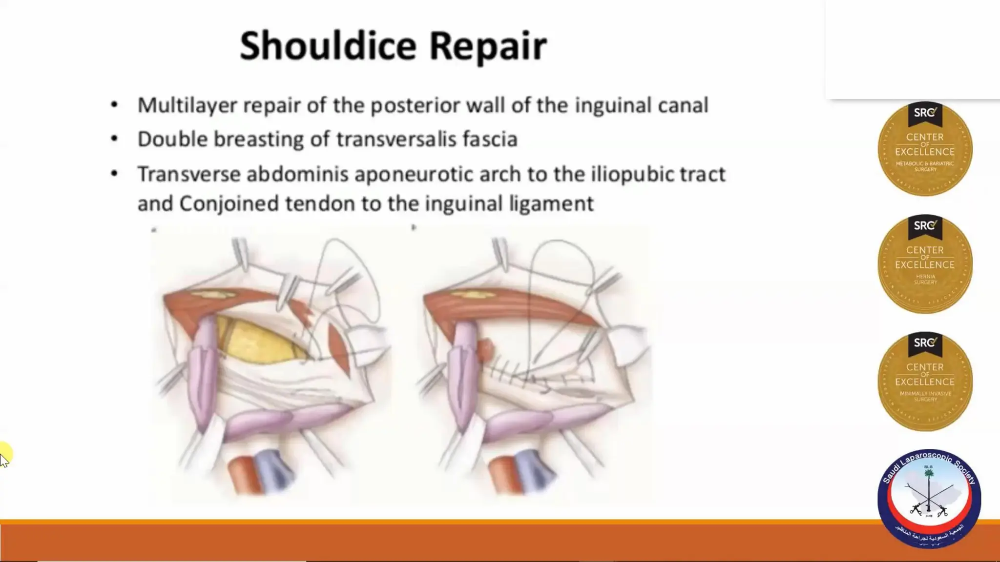 hernias surgical disease lectureand notes.pdf