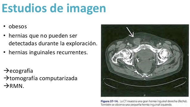 Hernias inguinales