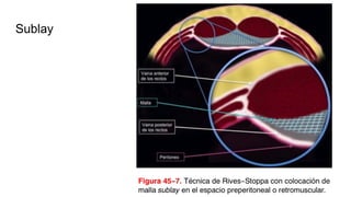 Hernias raras hernias insicionales hernias postoperatorias.pptx
