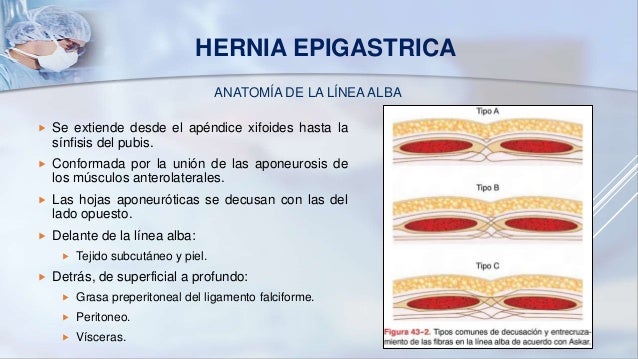 Linea Alba Hernia